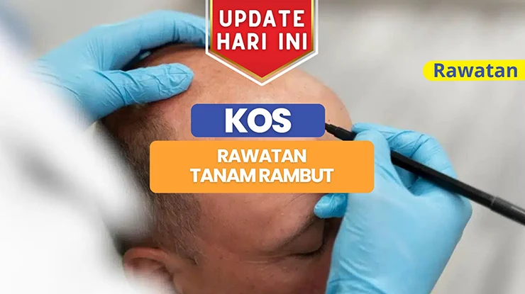 Kos Rawatan Tanam Rambut di Malaysia Terkini 2025